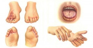 Candida (kandidóza, kvasinková infekcia): Príznaky a liečba